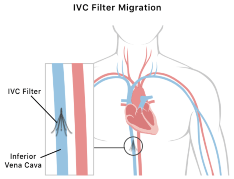 IVC Filters - RDP Law Group